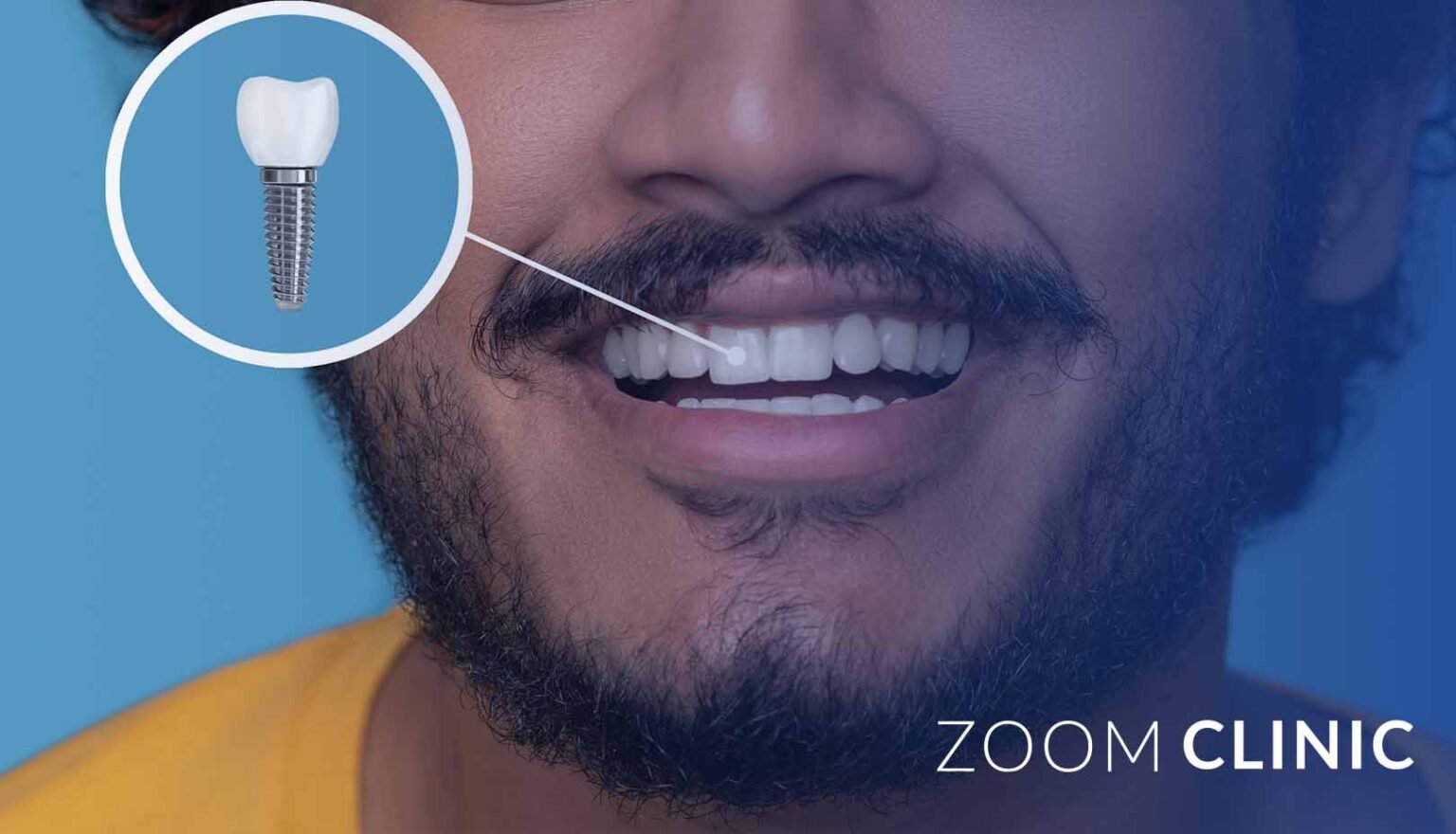 Dental Implants for Multiple Missing Teeth: Solutions and Strategies ...