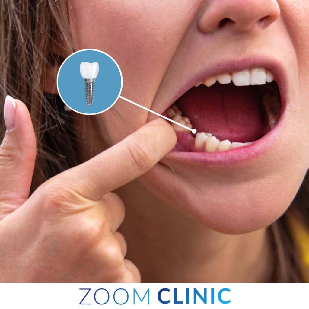 Dental Implants for Multiple Missing Teeth: Solutions and Strategies ...