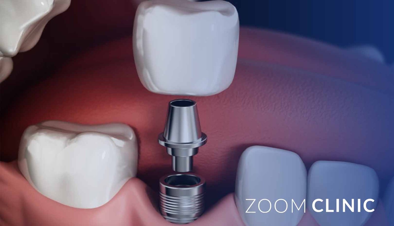 Dental Implants and Age: Are You Ever Too Old or Too Young for Implants ...