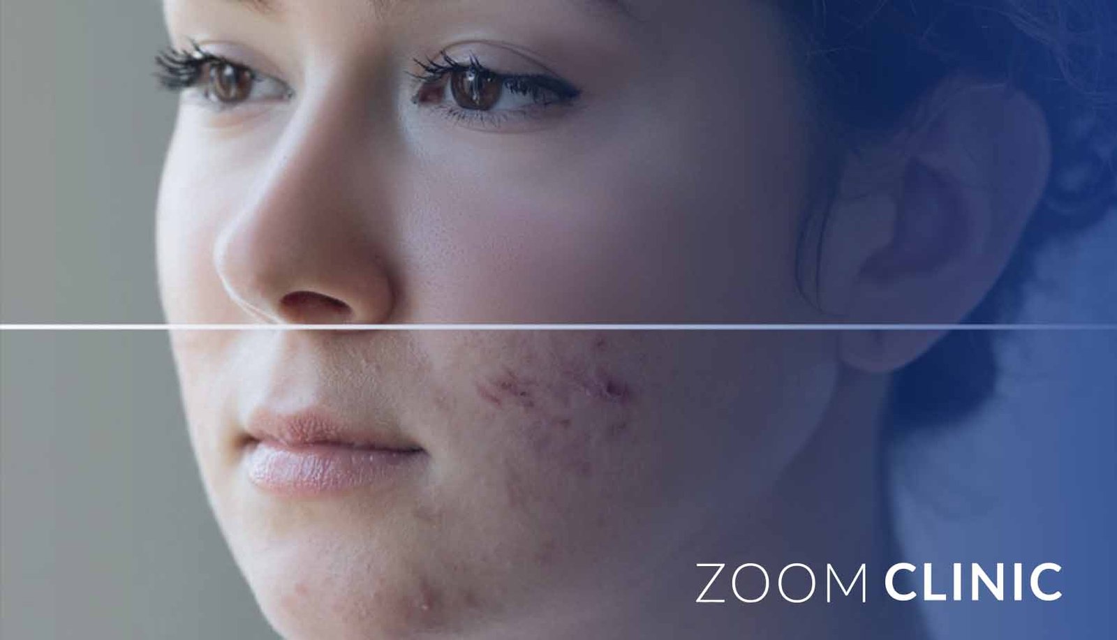 Surgical Options for Treating Severe Acne Scars: A Comprehensive Guide ...